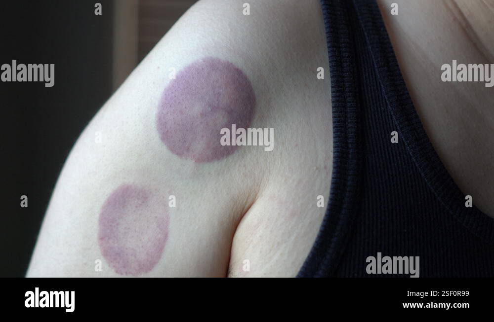 bruise marks from suction cups alternative therapy for blood ...