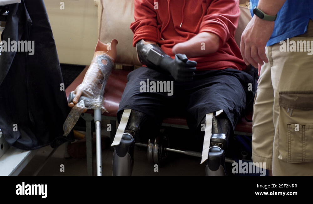 A man with amputated arms uses artificial bionic arm prosthesis moving ...