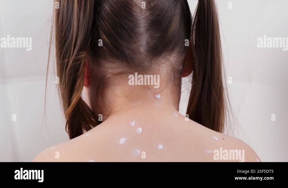 back girl with chickenpox, antiseptic cream applied to the rash. Rash ...