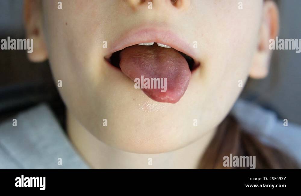 Wide open mouth with a tongue stuck out, view of the uvula and the soft ...