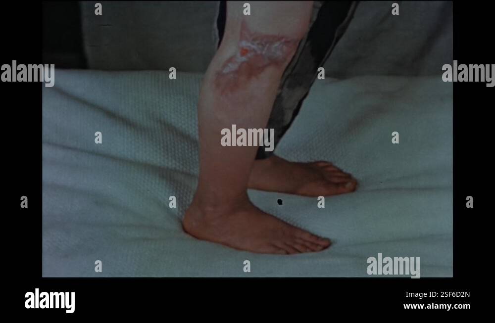 1940s: Burn marks on back. Wound on boy's leg, tilt up boy Stock Video ...