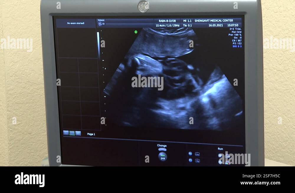 Sonography. The screen of the ultrasound machine Stock Video Footage ...