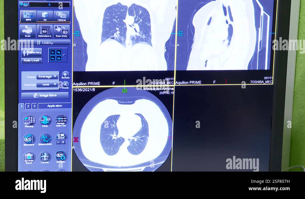 MRI scan screen animation. Computed medical tomography MRI Stock Video ...