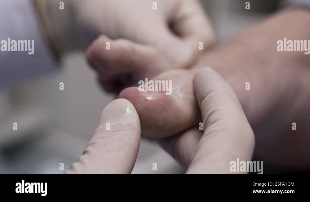 The doctor applies oil, the drug on the toes of the patient after the ...