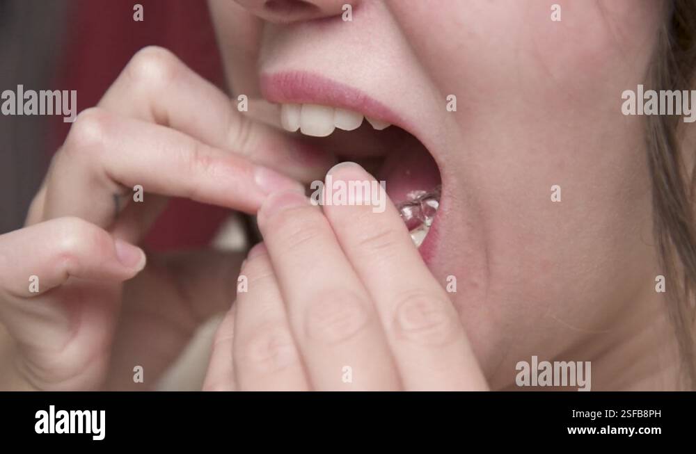 Mouth close-up A young woman puts a corrective aligner splint on her ...