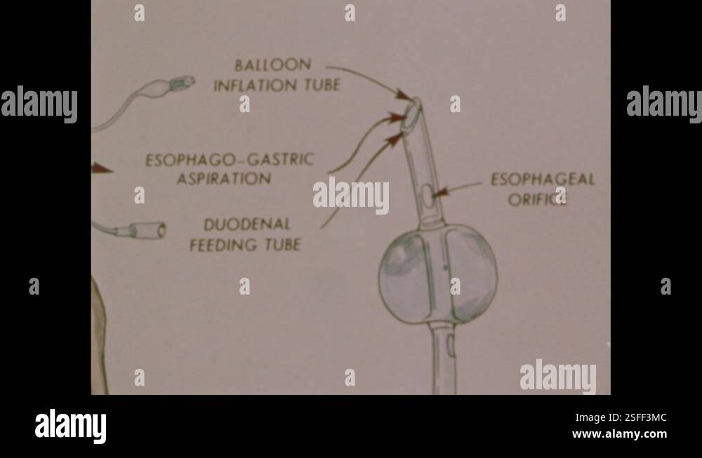1960s: Illustrated cross-section of Levin Tube. Illustrated cross ...