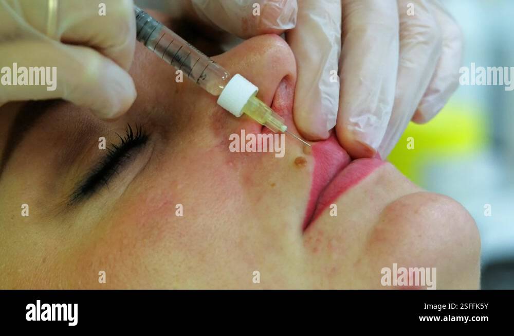 The cosmetologist makes injections on the client's face in the lip area ...
