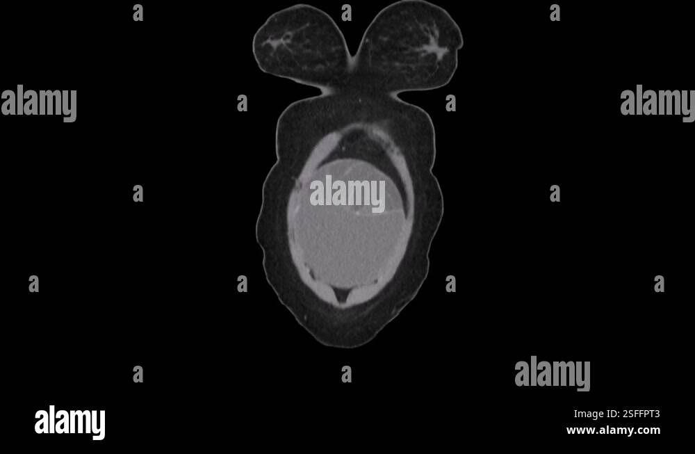 Abdominal cyst, CT scan Stock Video Footage - Alamy