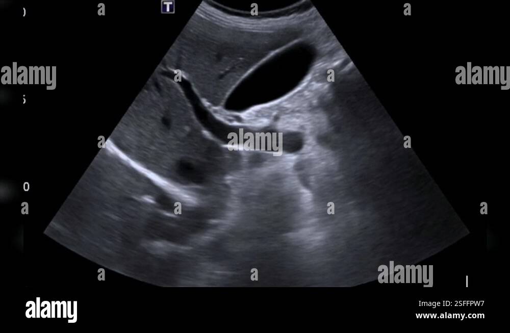 Gallbladder ultrasound scan Stock Videos & Footage - HD and 4K Video ...