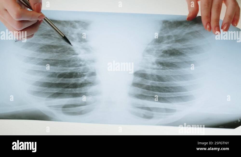 Lungs x-ray close-up. Doctor examining ribs roentgen, human chest ...