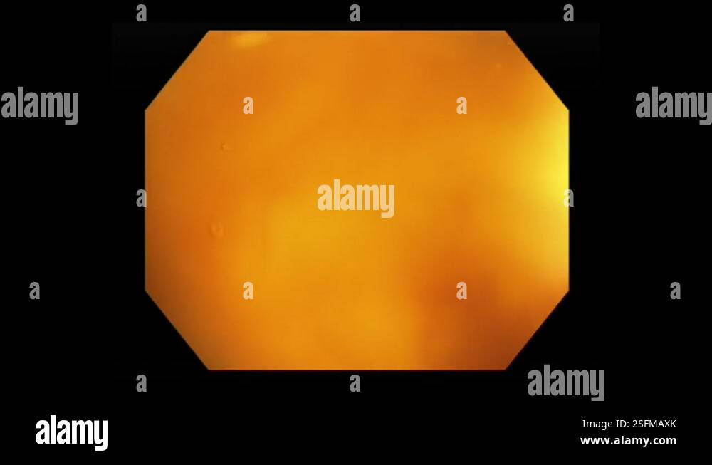 Doctor's View Inside Human's Intestine Through Colonoscopy Procedure ...