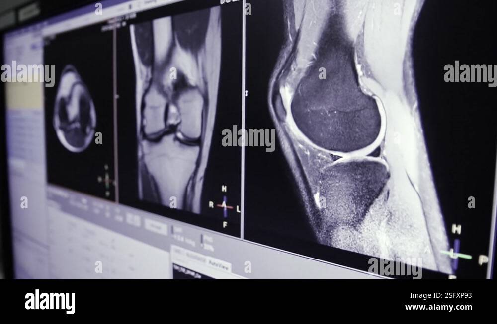 MRI Knee joint or magnetic resonance imaging of the knee for diagnosis ...