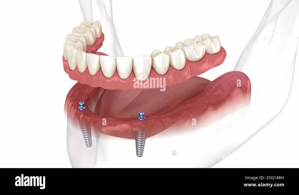 Mandibular removable prosthesis All on 2 system supported by implants ...