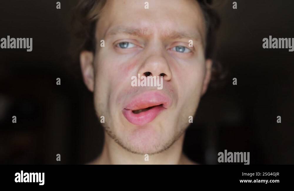 plump lips, allergic reaction of angioedema in a man on the lip Stock ...