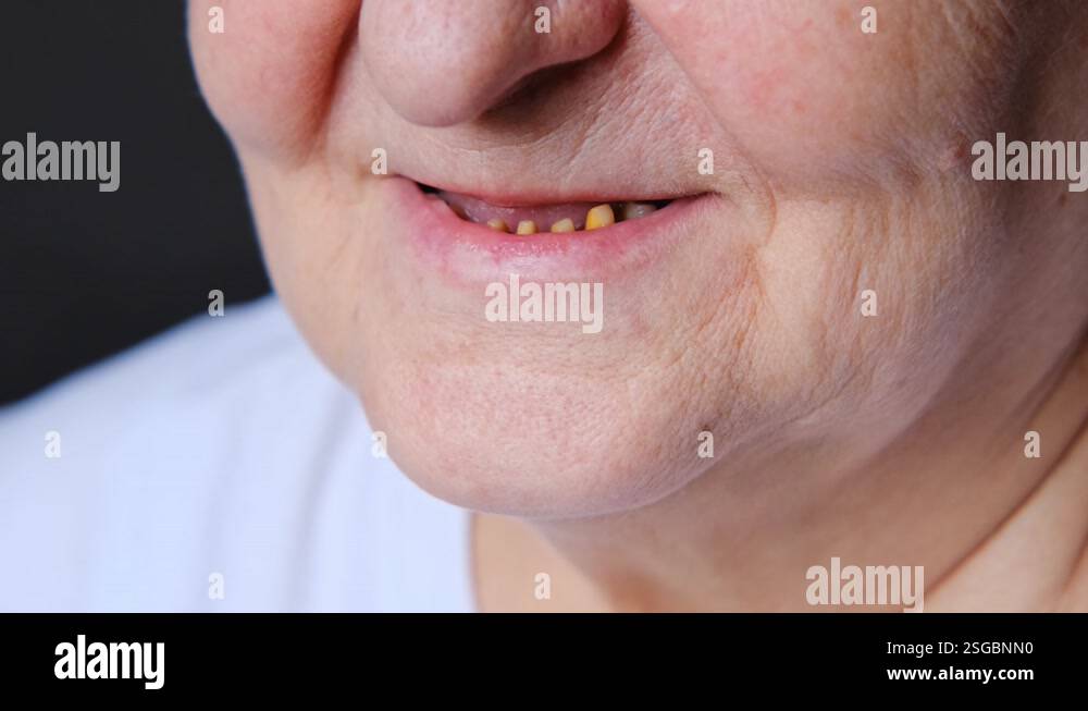 Toothless mouth with dental implants. Prosthetics, implantation of the ...