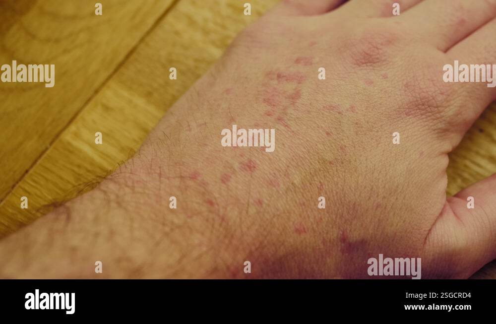 Food Allergy, Lot of red spots or rash on the skin all of a man hand ...