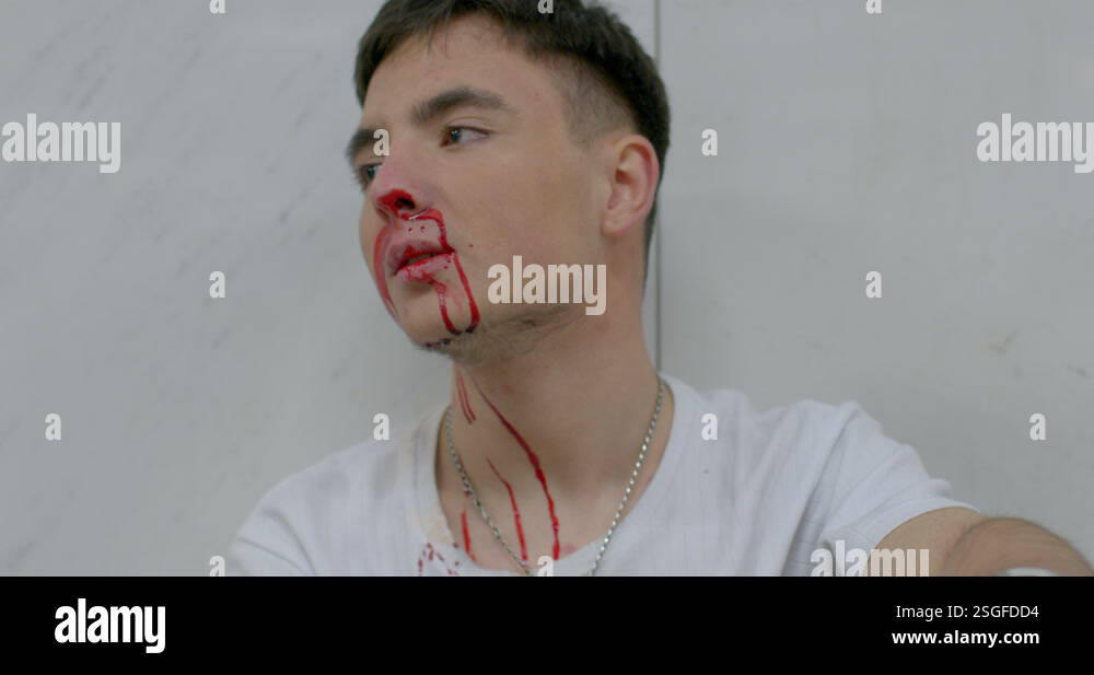 guy face after street fight. He sits light background broken nose Stock ...