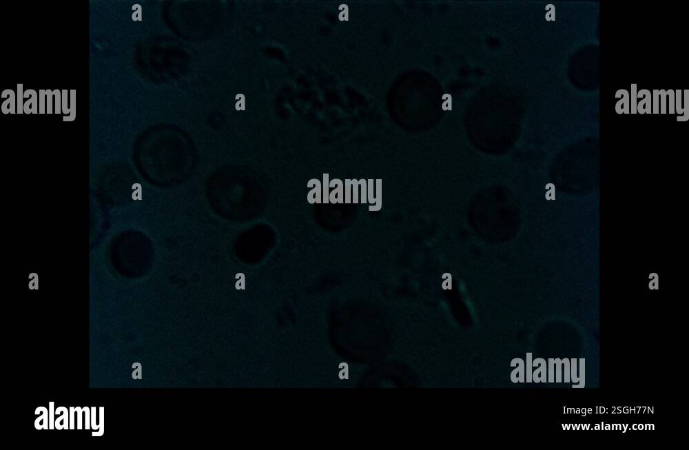 1950s: Microphotography of infected and deformed red blood cells Stock ...