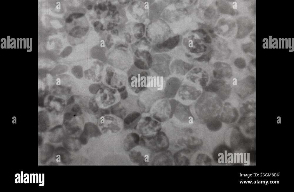 1960s: Microscopic view of irradiated bone marrow compared with healthy bone Stock Video Footage ...