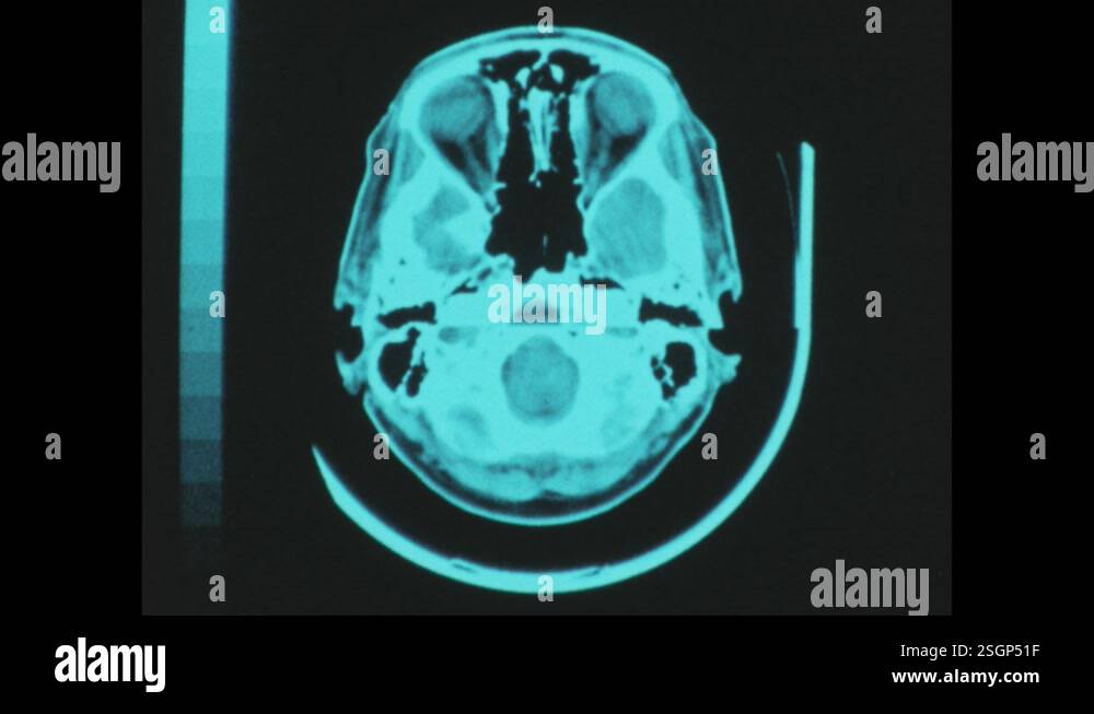 1980s: Patient enters CAT scan. Image of patients brain. Light spectrum ...