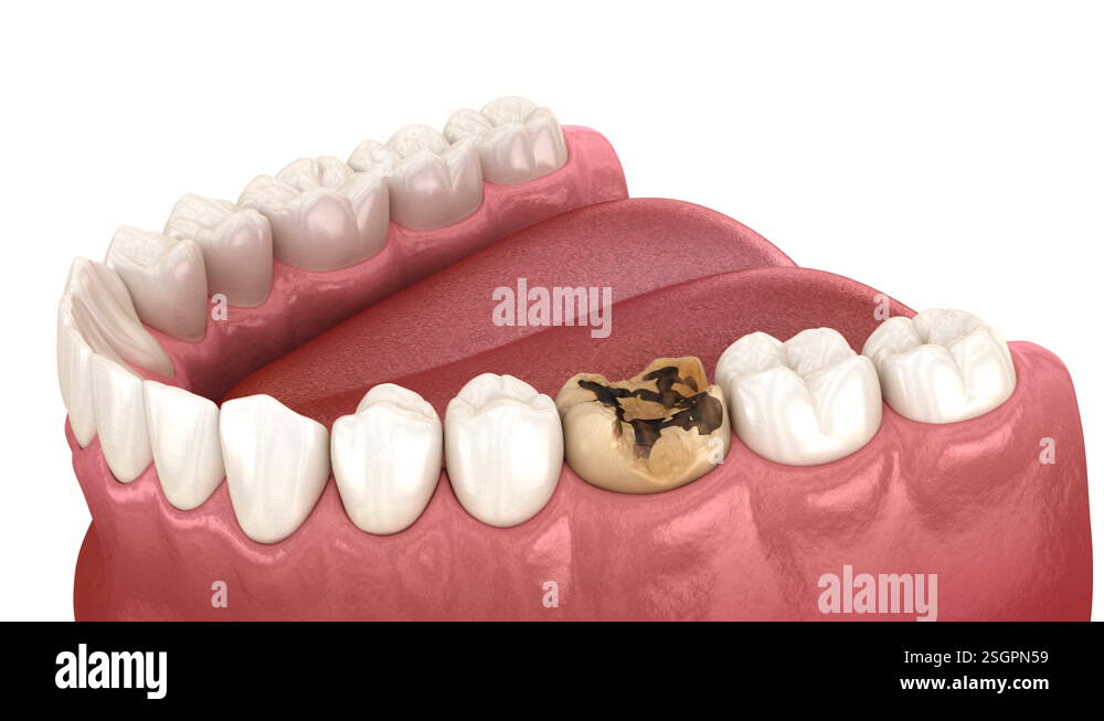 Caries removing, preparation, dental impression and crown placement ...