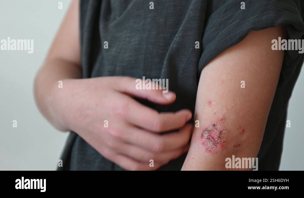 teenager scratching his hand with allergic lesions on the skin.skin of ...