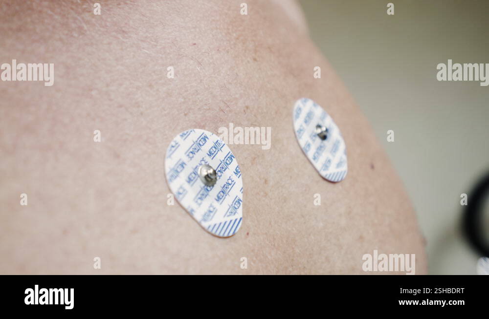 sensors sticker for electrocardiogram (ECG or EKG) applied on caucasian ...