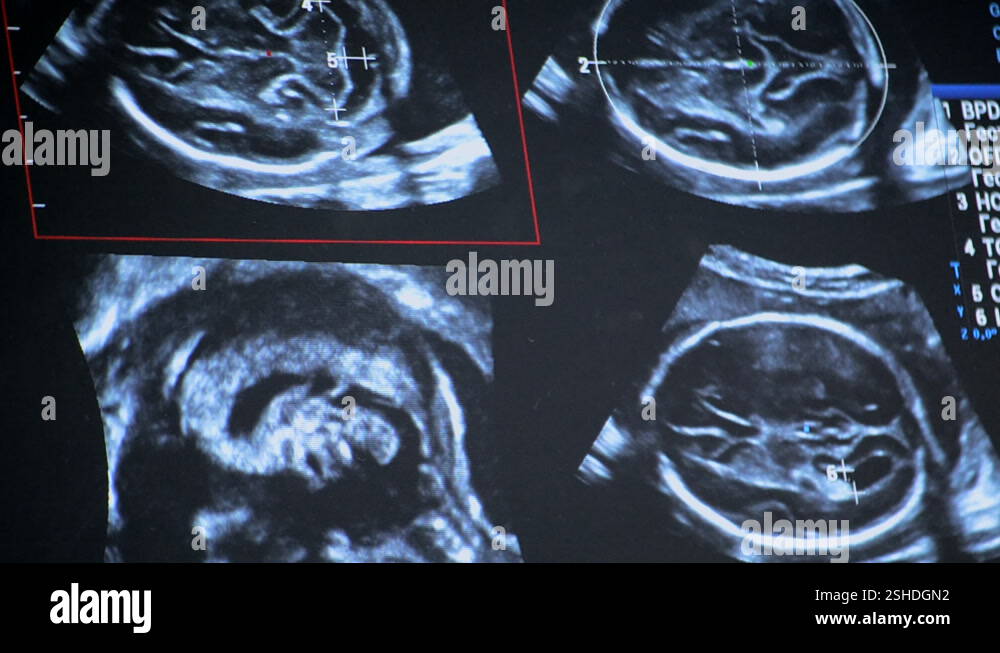 Utrasound image on monitor. Ultrasound Scan display. Screening ...
