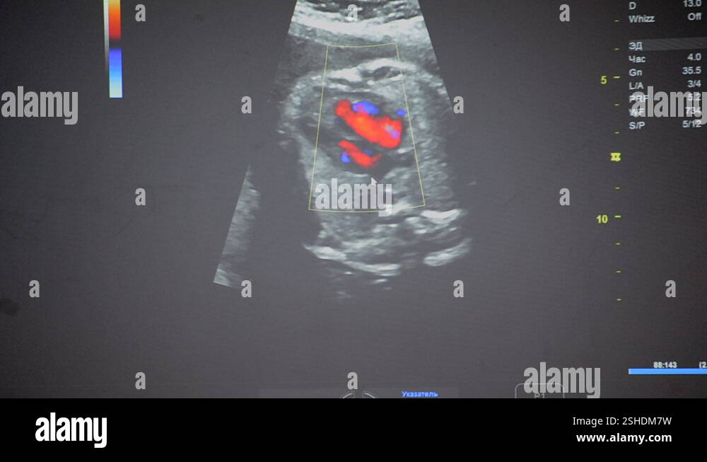 Utrasound image on monitor. Ultrasound Scan display. Screening ...