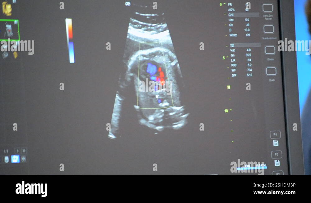 Utrasound image on monitor. Ultrasound Scan display. Screening ...