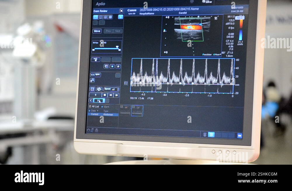Utrasound image on monitor. Ultrasound Scan display. Screening ...