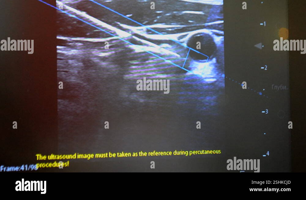 Utrasound image on monitor. Ultrasound Scan display. Screening ...