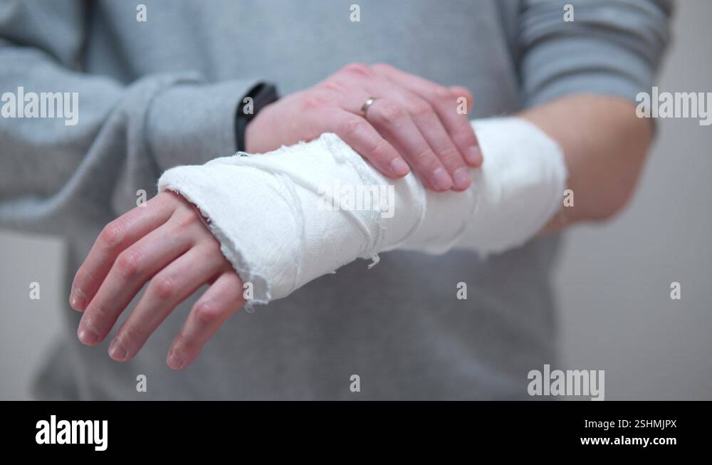 The broken arm of a man in gaps. Plaster cast on a broken arm close-up ...