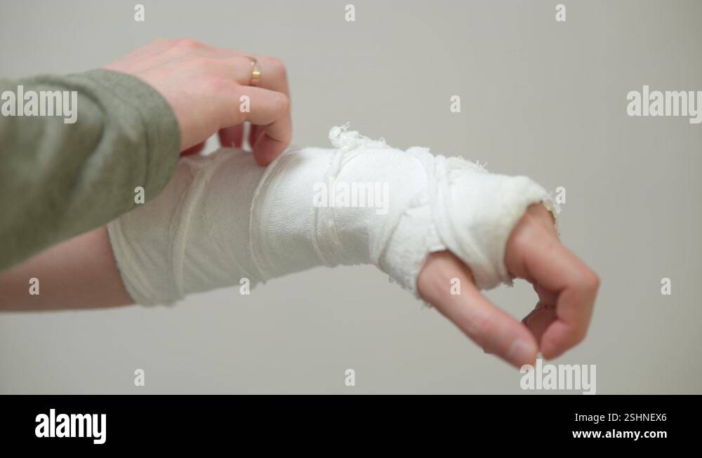 Man with plaster cast on arm. A broken arm in plaster Stock Video ...