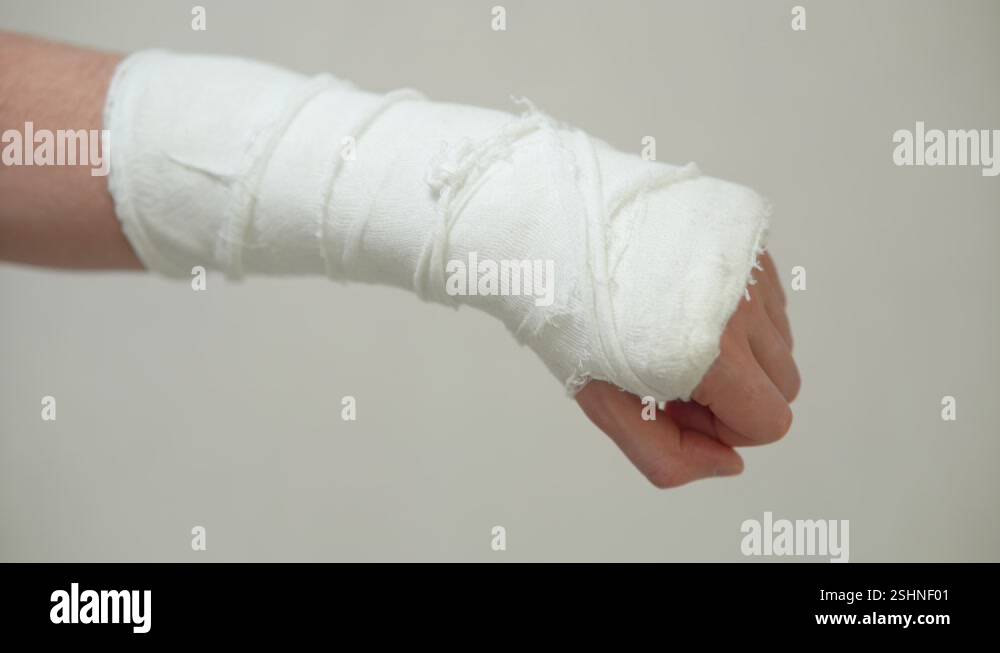 Man with plaster cast on arm. A broken arm in plaster Stock Video ...