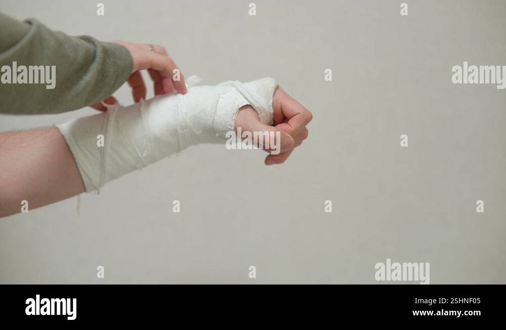 Man with plaster cast on arm. A broken arm in plaster Stock Video ...