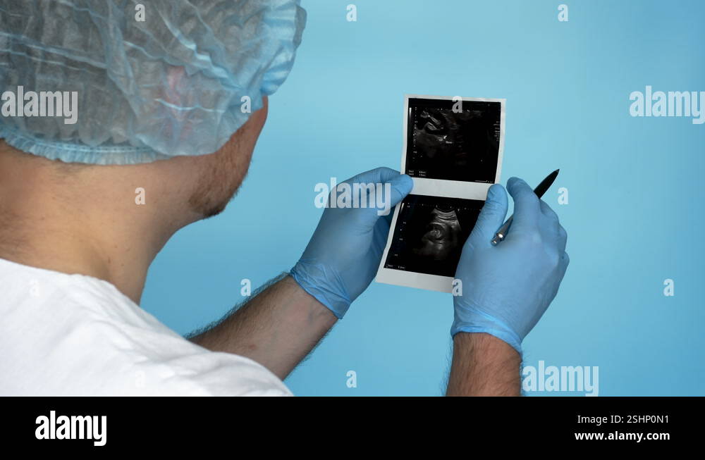 Ultrasound of the prostate gland of a man. Prostate adenoma Stock Video ...