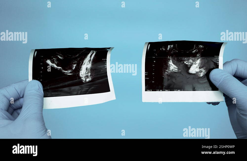 Ultrasound of the prostate gland of a man. Prostate adenoma Stock Video ...