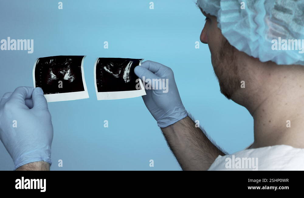 Ultrasound of the prostate gland of a man. Prostate adenoma Stock Video ...