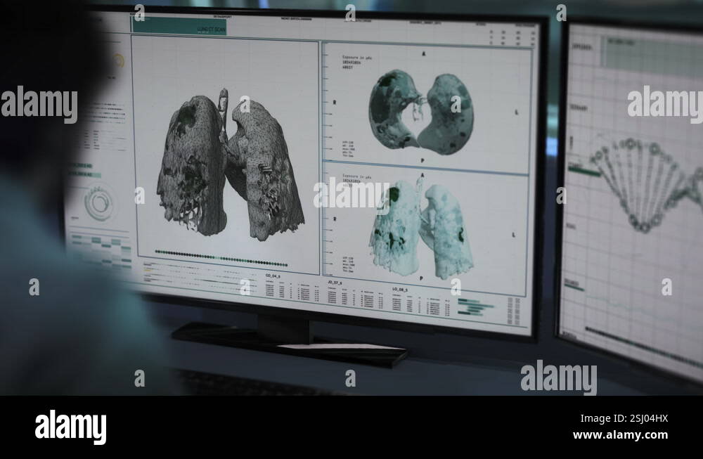 Evaluating the level of Covid-19 lung damage shown on CT scan report on ...