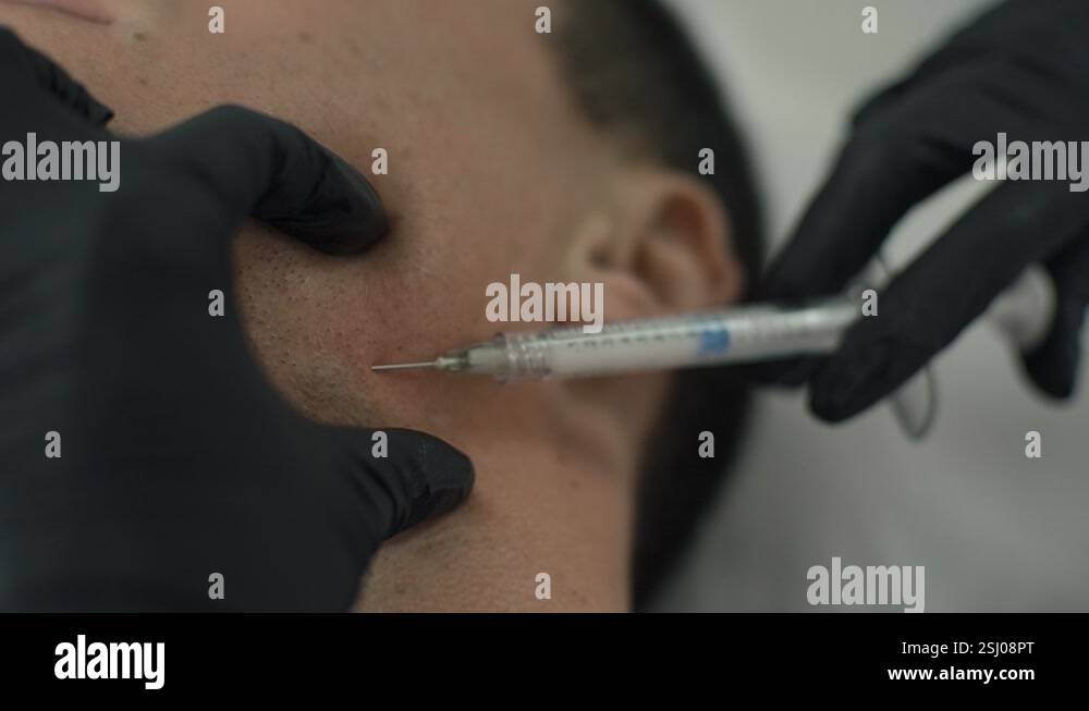 Injection Needle Syringe under the men Face Skin, tightening Procedure ...