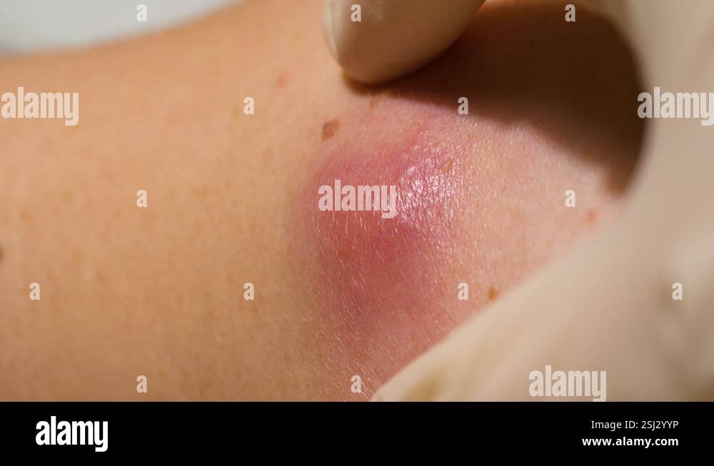 Inflamed atheroma examination, sebaceous cyst, skin closeup macro, fat ...