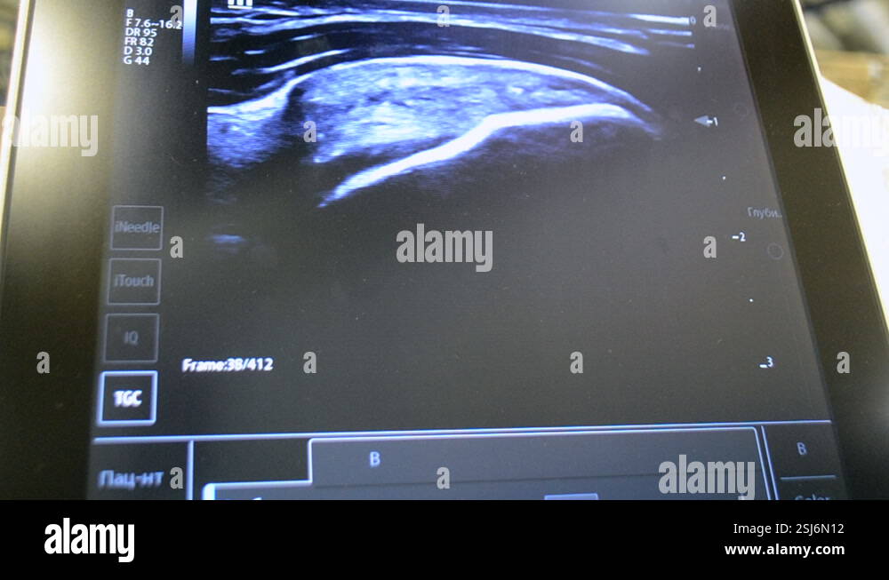 Ultrasound on monitor. Ultrasound image on computer monitor screen ...