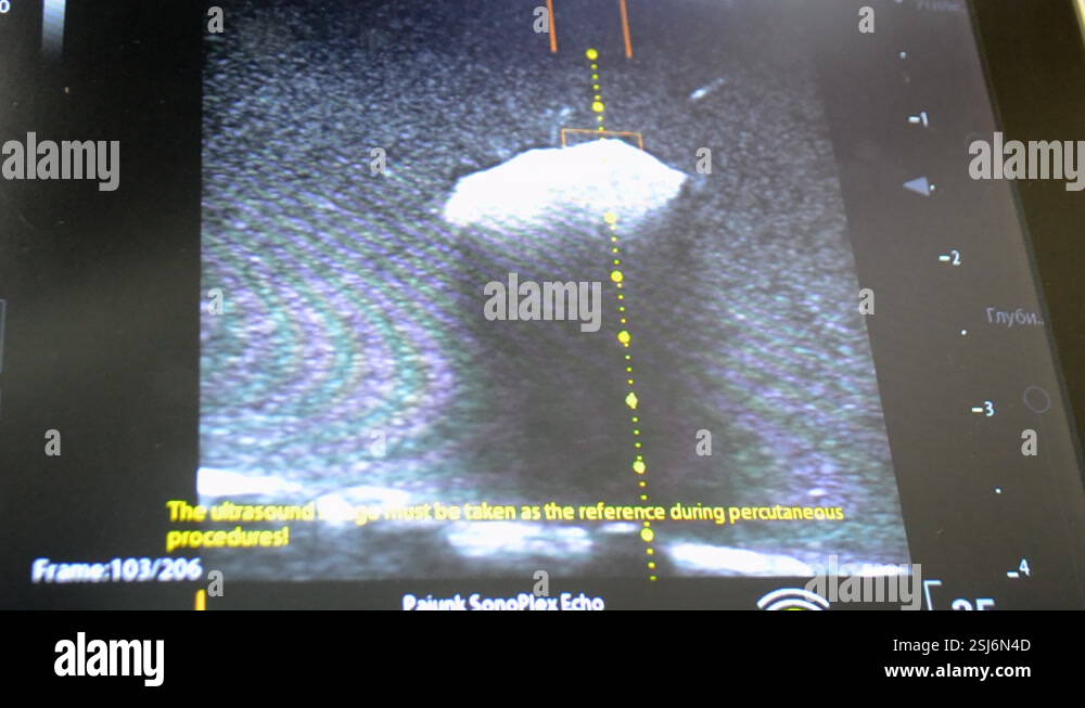 Ultrasound on monitor. Ultrasound image on computer monitor screen ...