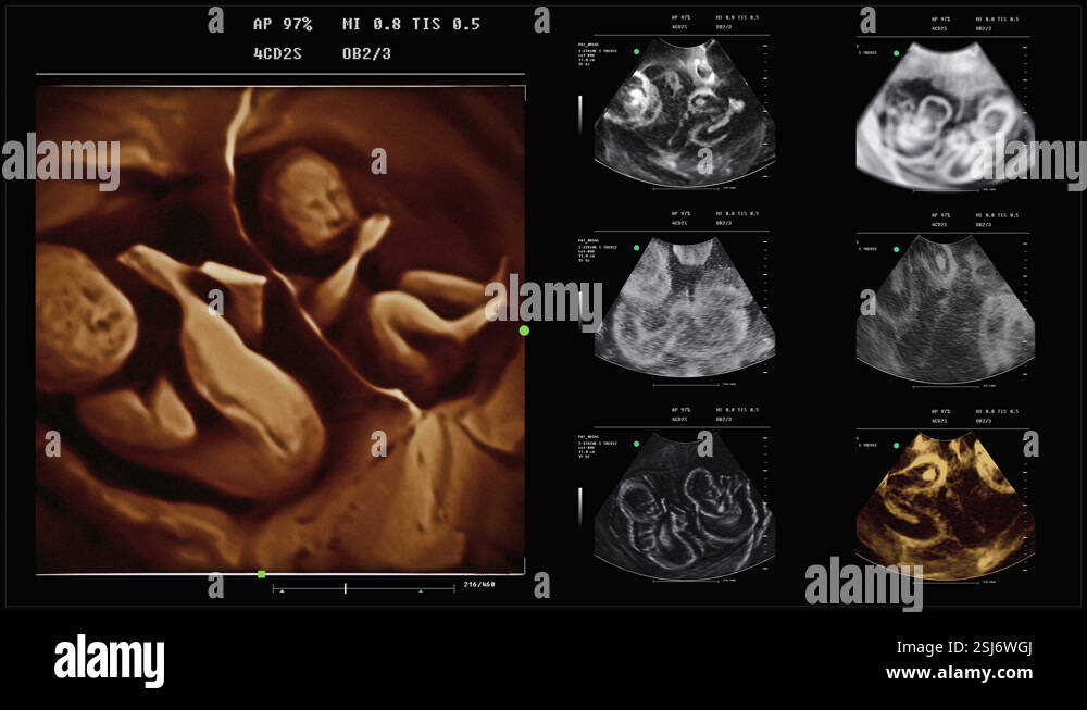 Ultrasound equipment shows healthy twin babies in the womb during ...