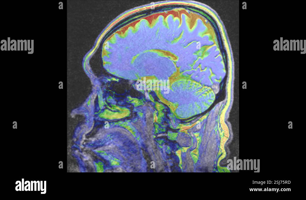 Healthy human brain, sagittal MRI scan sequence Stock Video Footage - Alamy
