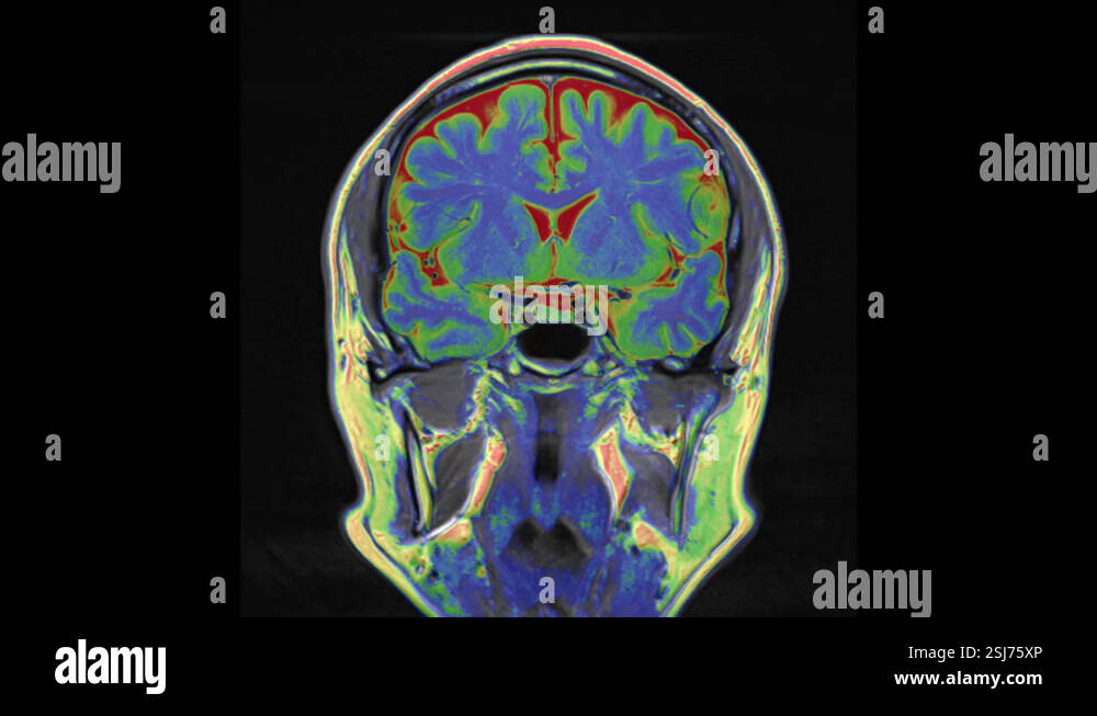 Healthy human brain, coronal MRI scan sequence Stock Video Footage - Alamy