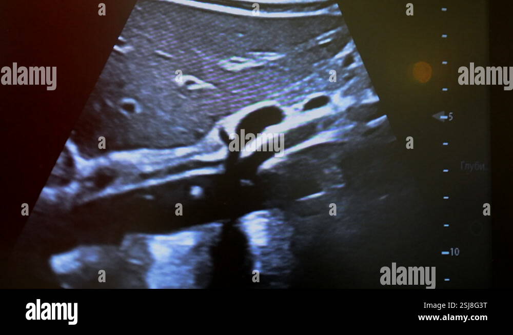 Ultrasound on monitor. Ultrasound image on computer monitor screen ...