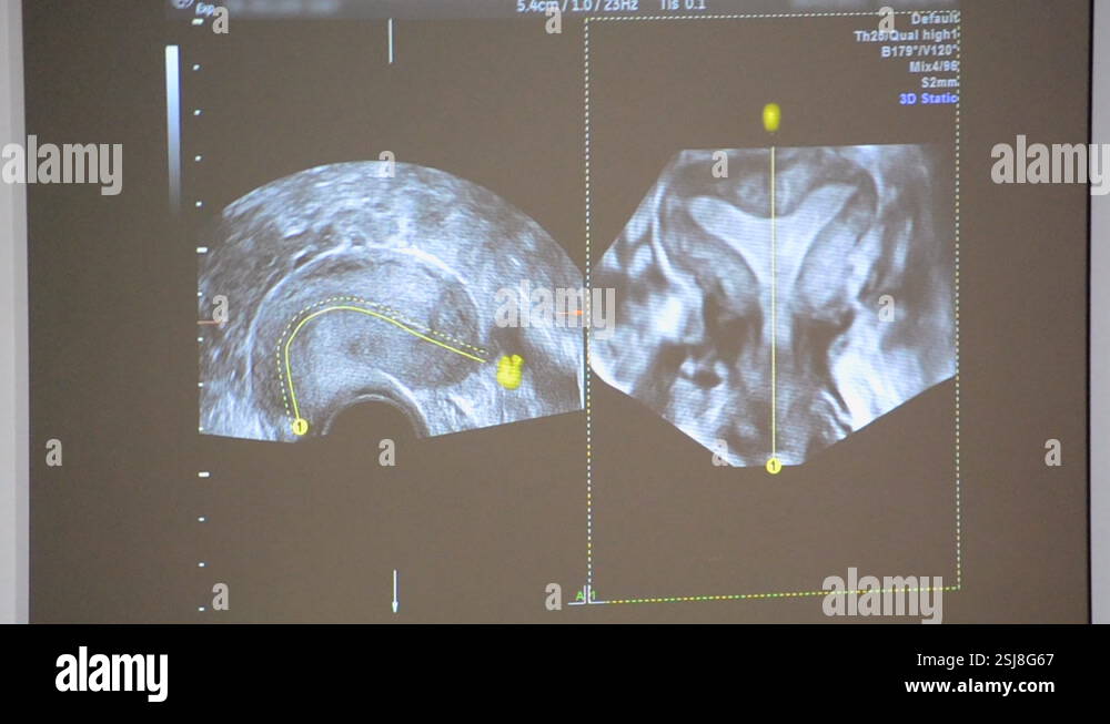 Ultrasound on monitor. Ultrasound image on computer monitor screen ...