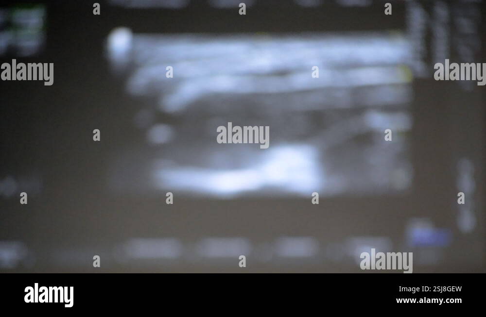 Blurred background. Utrasound image on the monitor close-up. Ultrasound ...